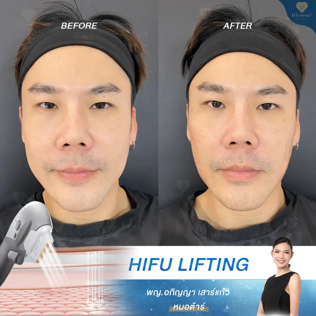 HIFU คืออะไร ราคาเท่าไหร่ - D' Lovevery Clinic