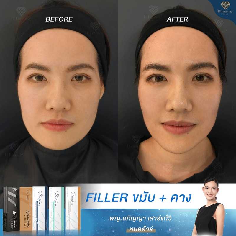 ฟิลเลอร์ขมับ ฉีดยี่ห้อไหน ราคาเท่าไหร่ - D' Lovevery Clinic