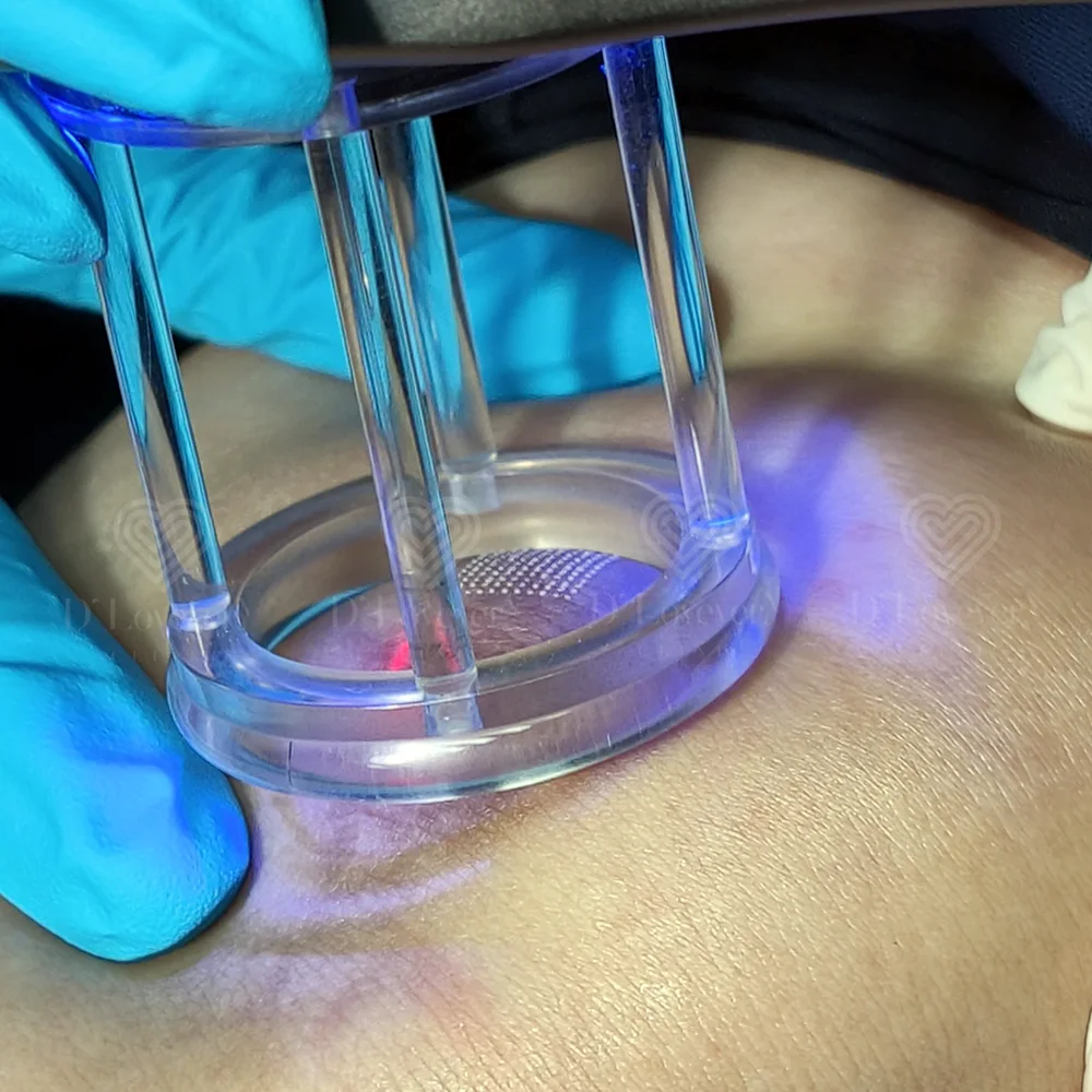 How many laser scar treatments are needed to see results? - D' Lovevery ...