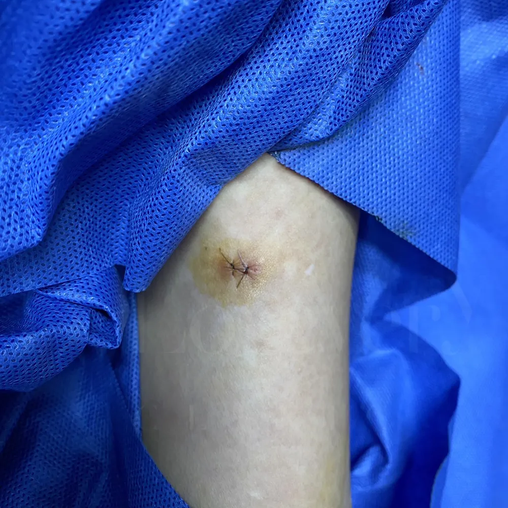 Will a contraceptive implant scar turn into a keloid? - D' Lovevery Clinic
