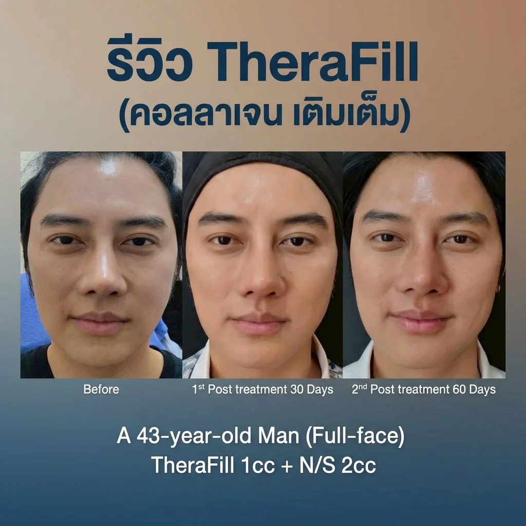 What is TheraFill? What are the benefits of fresh collagen? Who is it ...